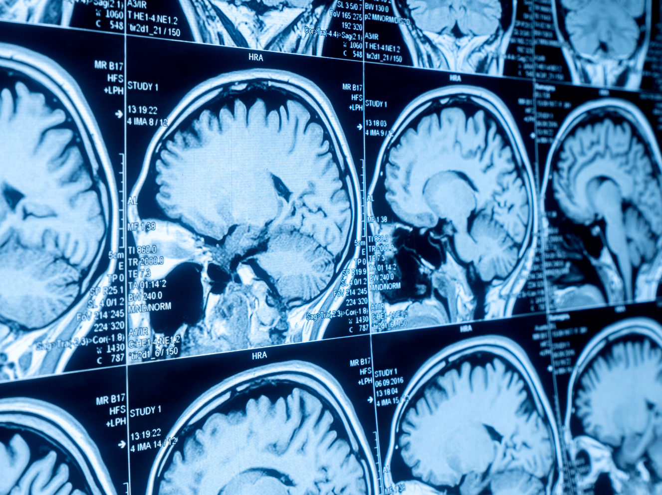 Hjärntumör grad 4: Symptom, behandling och överlevnad